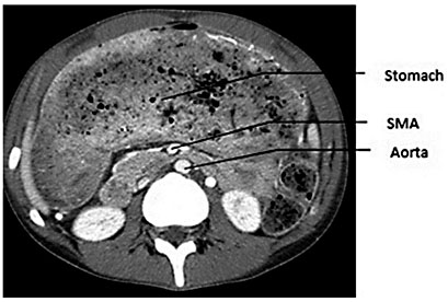 Wilkie's Syndrome or Superior Mesenteric Artery Syndrome: Fact or ...