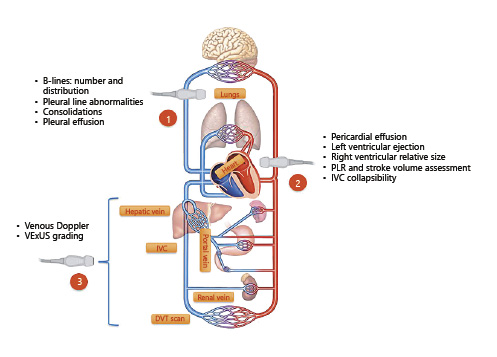 Need for Objective Assessment of Volume Status in Critically Ill ...