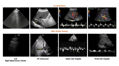 Need for Objective Assessment of Volume Status in Critically Ill ...