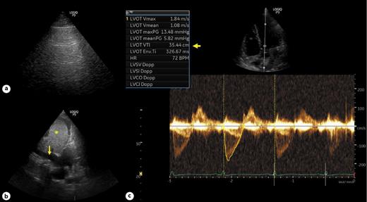 Albumin Infusion in Patients with Cirrhosis: Time for POCUS-Enhanced ...