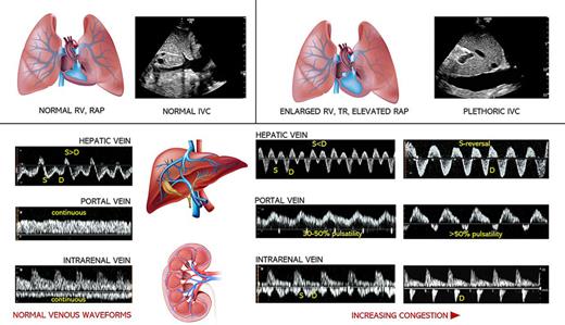 Bedside Ultrasound in the Management of Cardiorenal Syndromes: An ...