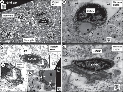 Cardiorenal Metabolic Syndrome and Diabetic Cognopathy | Cardiorenal ...