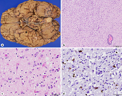 A Fatal Case of Herpes Simplex Encephalitis with Two False-Negative ...