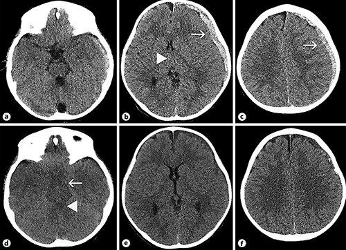 Swift Spontaneous Regression of a Pediatric Traumatic Acute Subdural ...