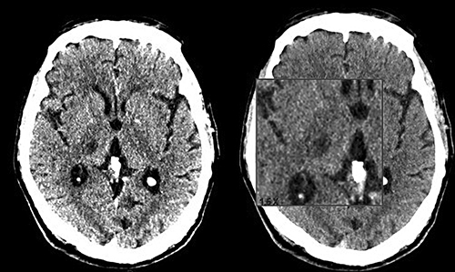 Posterior Variant of Alien Limb Syndrome with Sudden Clinical Onset as ...