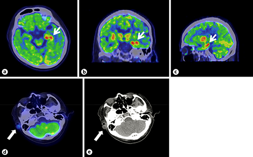 A Patient with Limbic Encephalitis, Ear Perichondritis, and ...