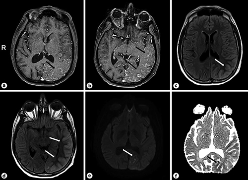 SMART Syndrome Identification and Successful Treatment | Case Reports in Neurology | Karger ...