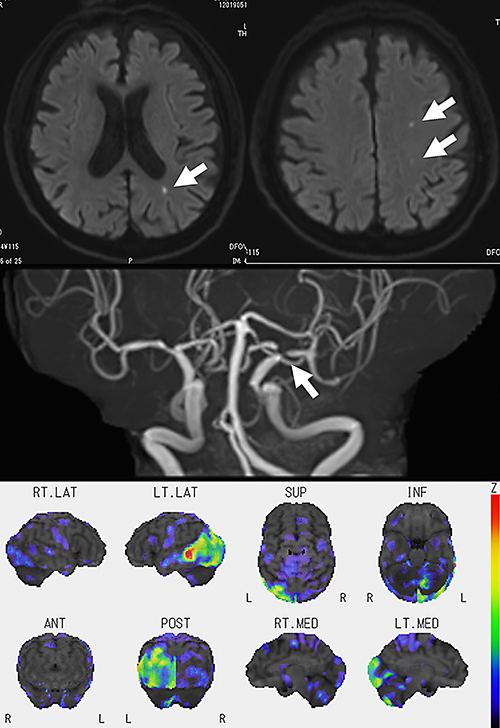 Luxury Perfusion Producing Sensory Aphasia | Case Reports in Neurology ...