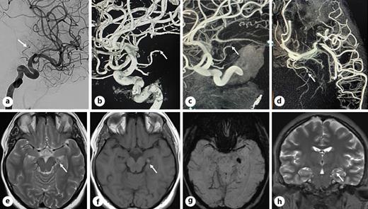 A Case of Anterior Choroidal Artery Occlusion and Stroke Secondary to ...