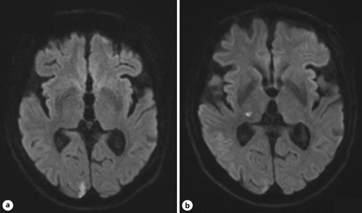 Yellow-Coloured Left Homonymous Visual Hemi-Field after Ischaemic ...