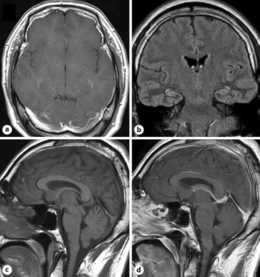 Frontotemporal Brain Sagging Syndrome as a Treatable Cause Mimicking ...