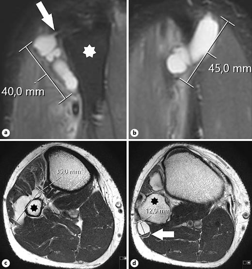 Large Intraneural Ganglion Cyst in the Peroneal Nerve | Case Reports in ...