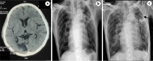 The Development of Pulmonary Edema after Recombinant Tissue Plasminogen ...