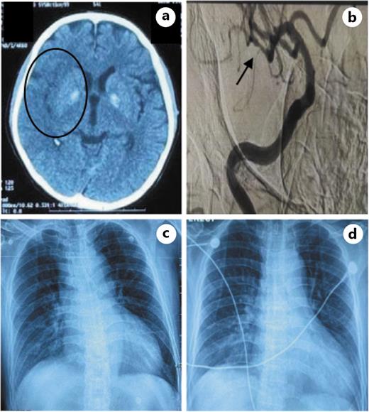 The Development of Pulmonary Edema after Recombinant Tissue Plasminogen ...