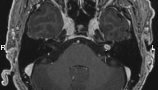 Vestibular Schwannoma Presenting as Acute Vertigo Mimicking Vestibular ...
