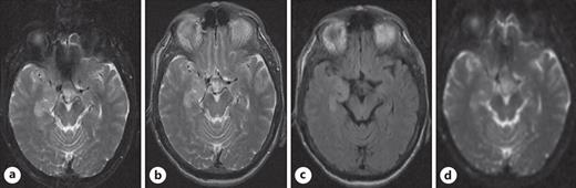 Encephalitis as a Clinical Manifestation of COVID-19: A Case Series ...