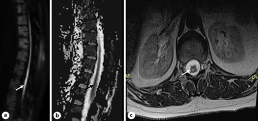 A Rare Case of Cardioembolic Spinal Stroke in a Young Female: Case ...
