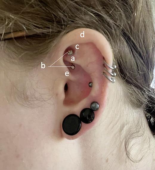 Migraine Symptoms Induced by an Auricular Piercing in a 27-Year-Old ...