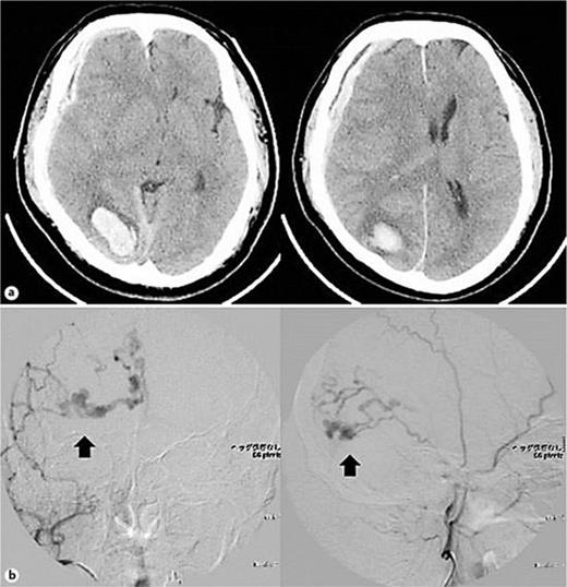 A Case of Dural Arteriovenous Fistula Presenting as Acute Subdural ...
