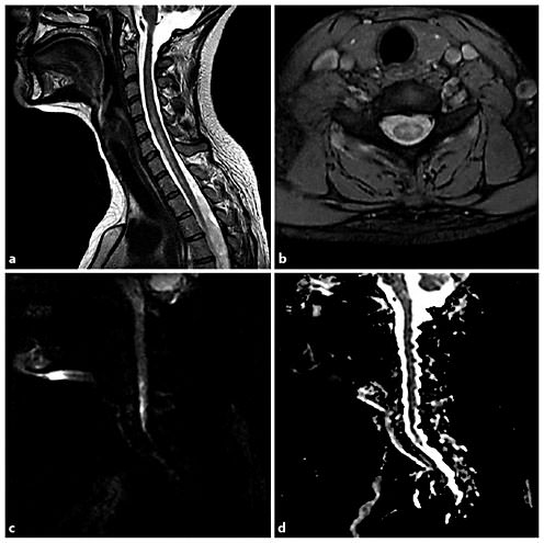 Spinal Cord Infarction and Patent Foramen Ovale: Is There a Link | Case ...