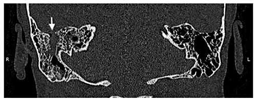 Gradenigo Syndrome: Unusual Consequence of Otitis Media | Case Reports ...