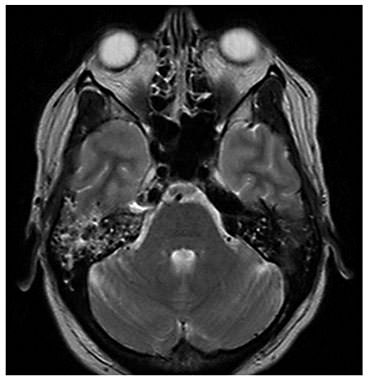 Gradenigo Syndrome: Unusual Consequence of Otitis Media | Case Reports ...