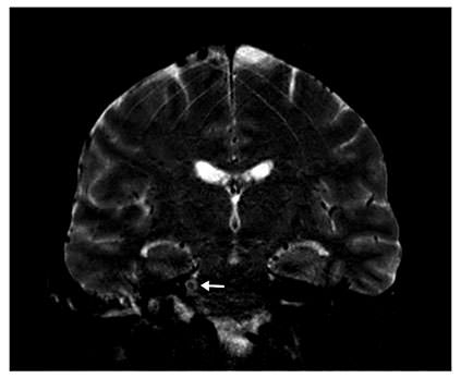 Gradenigo Syndrome: Unusual Consequence of Otitis Media | Case Reports ...