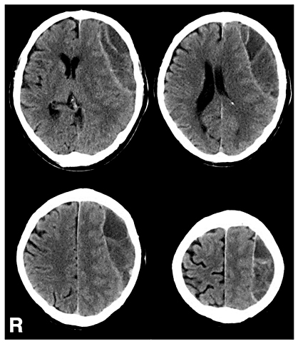 Chronic Subdural Hematoma Infected by Propionibacterium Acnes: A Case ...