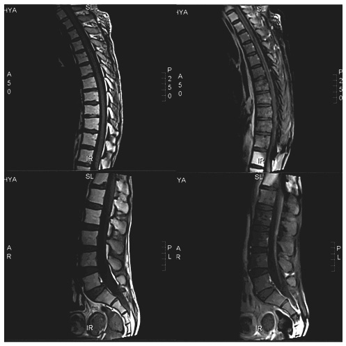 Cauda Equina Syndrome Secondary to Leptomeningeal Carcinomatosis of ...