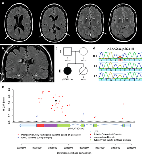 TUBB2B Mutation in an Adult Patient with Myoclonus-Dystonia | Case ...