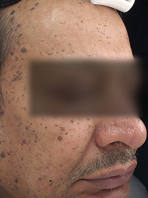 Leser-Trélat Sign Presenting in a Patient with Relapsing Mycosis ...