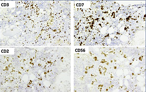 Role of Imaging in Diagnosis of a Rare Hepatosplenic Gamma Delta T-Cell ...