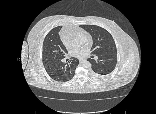 Primary Pleural Extranodal Marginal Zone Lymphoma Presenting as ...