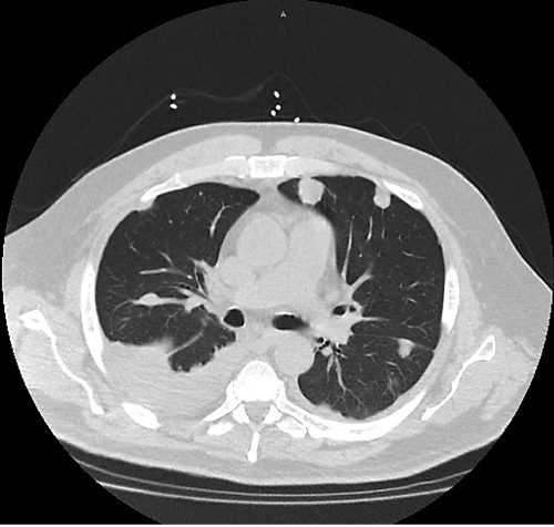 When the Tumor Lyses: A Case Report on Spontaneous Tumor Lysis Syndrome ...