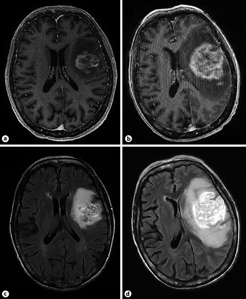 Rapid Progressive Glioblastoma despite Radiation in a Patient with Myelodysplastic Syndrome ...