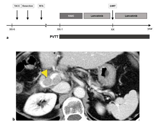 Controlling Major Portal Vein Invasion Progression during Lenvatinib ...
