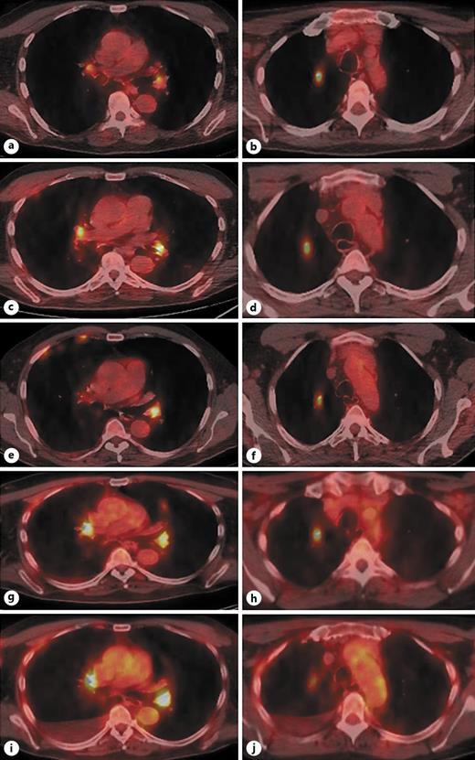 Therapy of Angiosarcoma with Thalidomide and Lenalidomide | Case ...