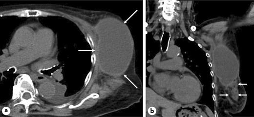 Prolonged Large Seroma Formation after Breast-Conserving Therapy | Case ...
