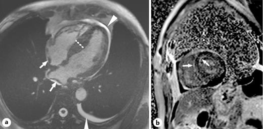 Do Not Ignore Those Raccoon Eyes; They May Indicate Lethal AL ...