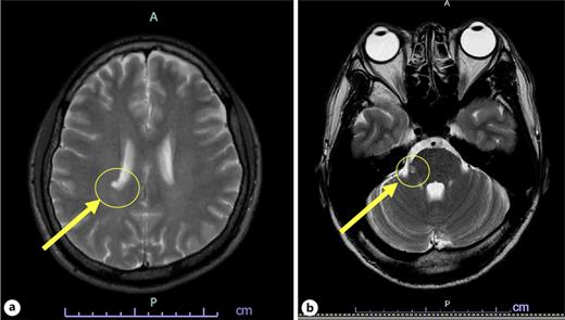 Entrectinib Response To Ros1 Fusion Positive Non Small Cell Lung Cancer