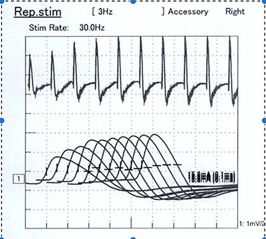 A Rare Case of Lambert-Eaton Myasthenia Syndrome Associated with Non ...