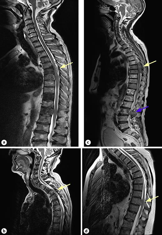 Case Series: “Silent” Spinal Epidural Metastases in Metastatic Castrate ...