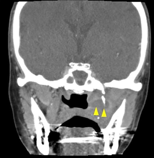 Pterygoid Muscle Necrosis Caused by Radiation and Intra-Arterial ...