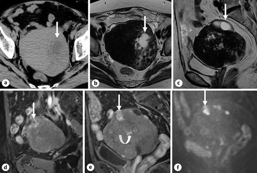 A Case Report Ovarian Fibrothecoma With Minor Sex Cord Elements Case