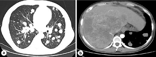 Naproxen in High-Temperature Neoplastic Fever: A Case Report ...
