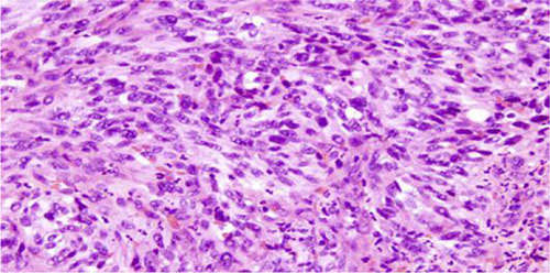 Primary Anorectal Melanoma | Case Reports in Oncology | Karger Publishers