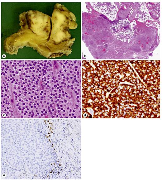 Multifocal Adenomatous Oncocytic Hyperplasia of the Parotid Gland ...