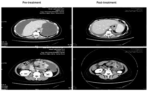 Pseudomyxoma Peritonei: Symptom Control and Objective Radiological ...