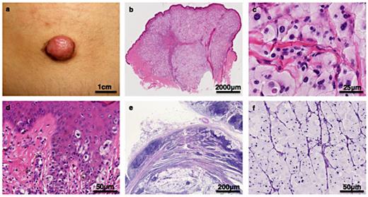 Balloon Cell Malignant Melanoma in a Young Female: A Case Report and ...