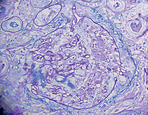 Disseminated Mucormycosis in a Patient with Recent Kidney ...